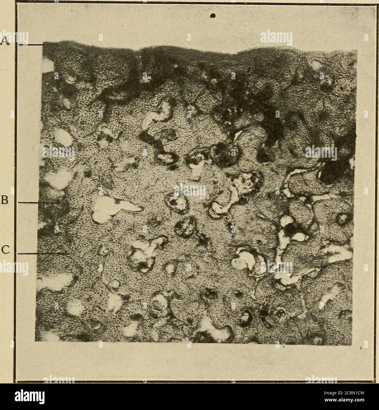 Pagets disease of bone hi-res stock photography and images - Alamy