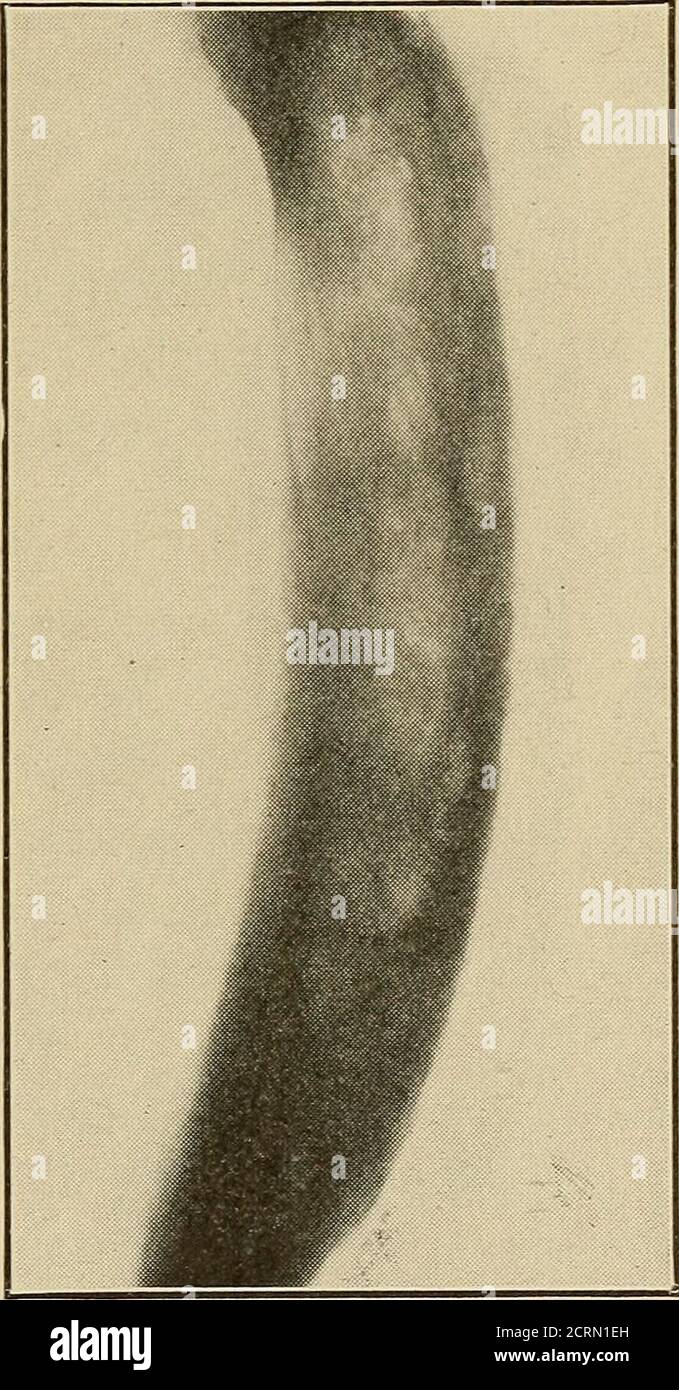 . Diseases of bones and joints . Fig. 78. Photomicrograph of section of ...