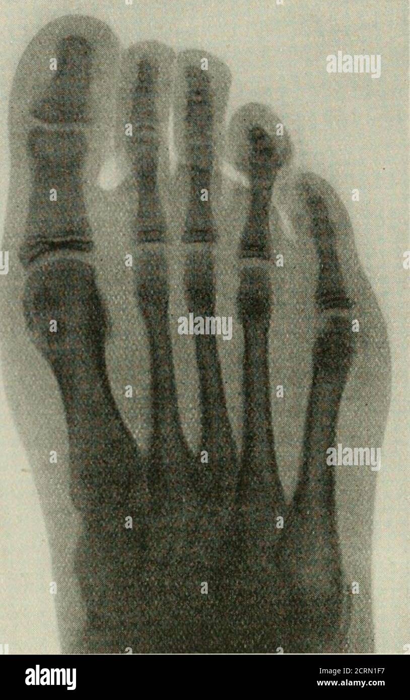 Epiphyses of the femur hi-res stock photography and images - Alamy