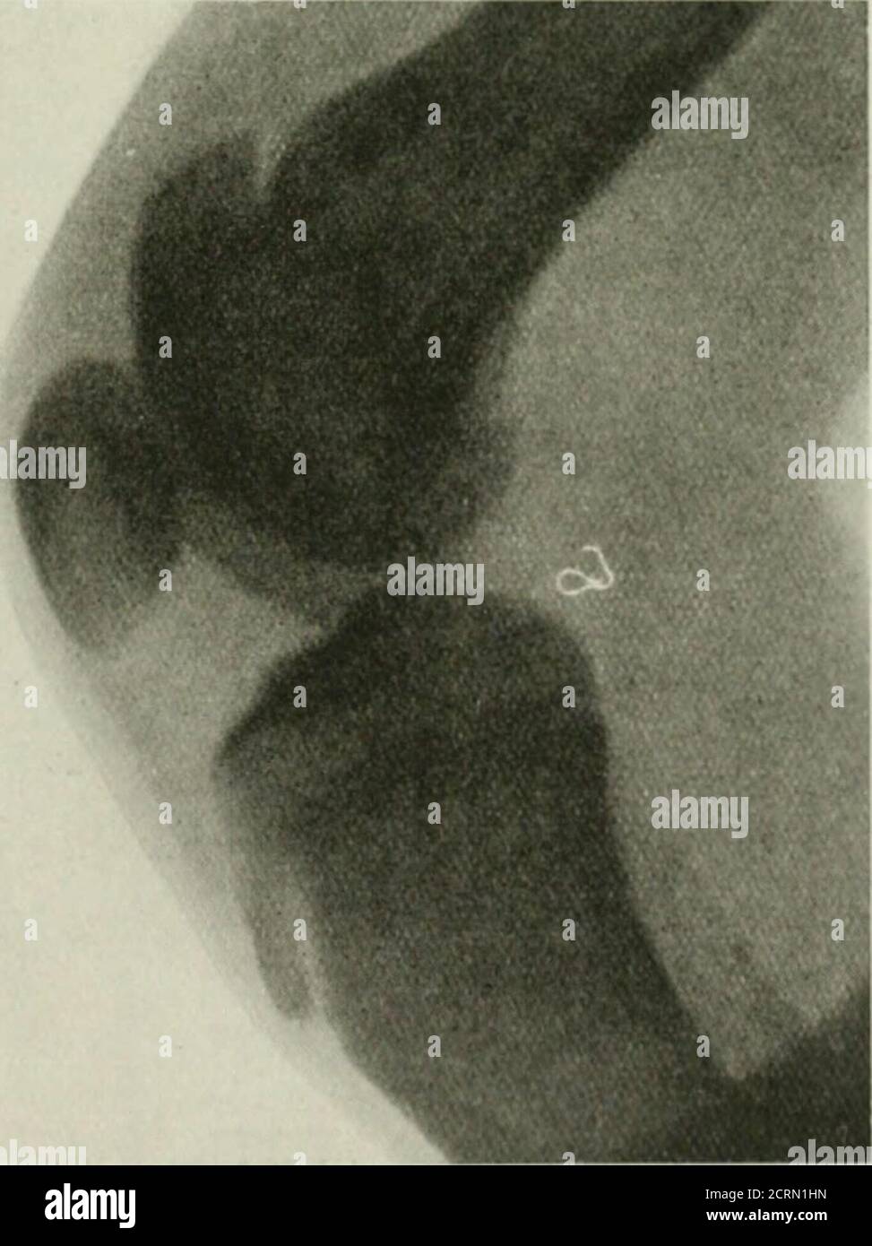 . Radiography and radio-therapeutics . Epiphyseal line Patella Aiitero ...