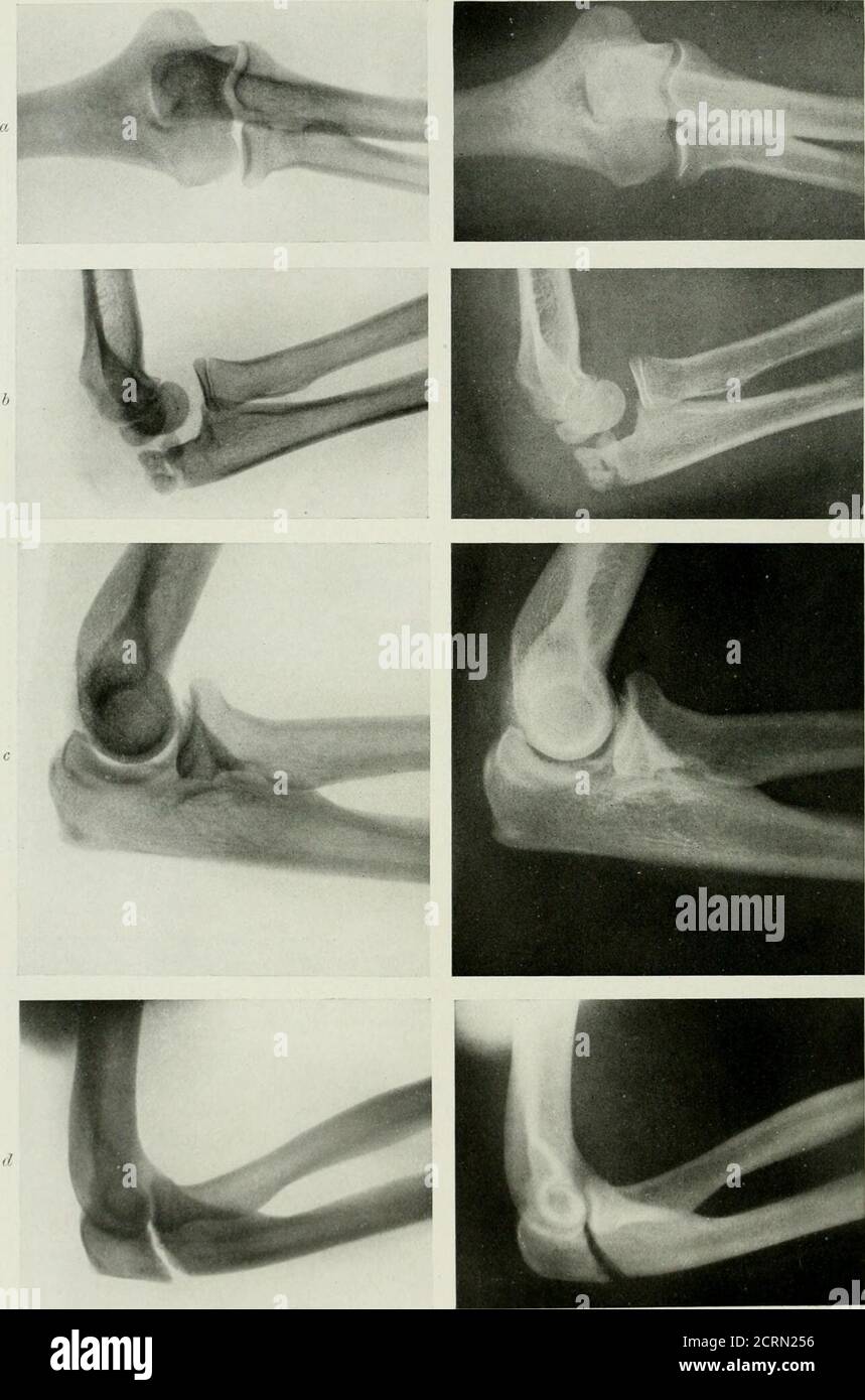 Olecranon process fracture hi-res stock photography and images - Alamy