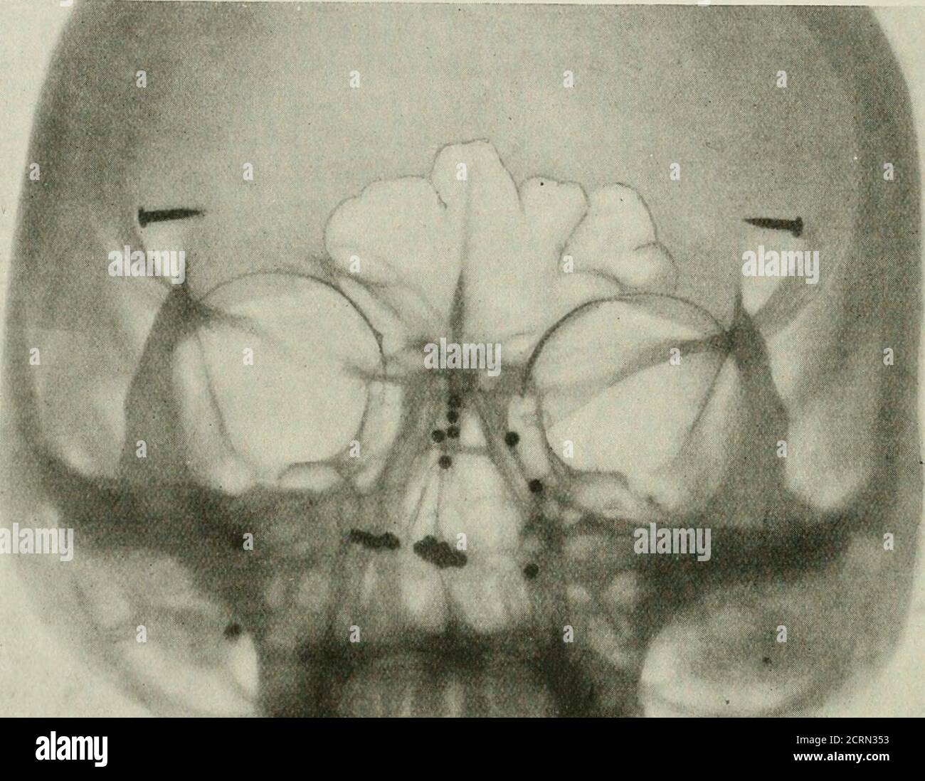 . Radiography and radio-therapeutics . Fig. 174.—ArrangciiKiit l ai ...