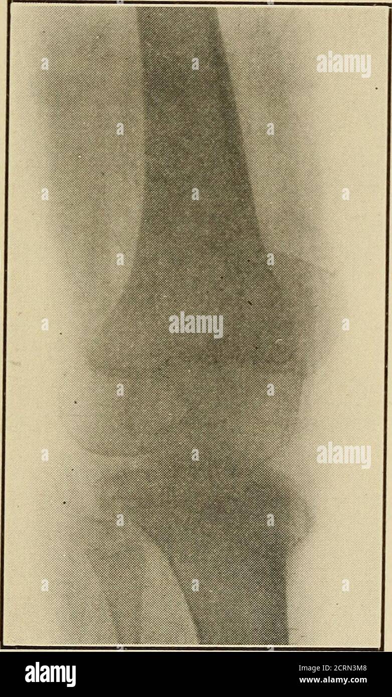 . Diseases of bones and joints . Fig. 40. Chronic gonorrheal arthritis ...