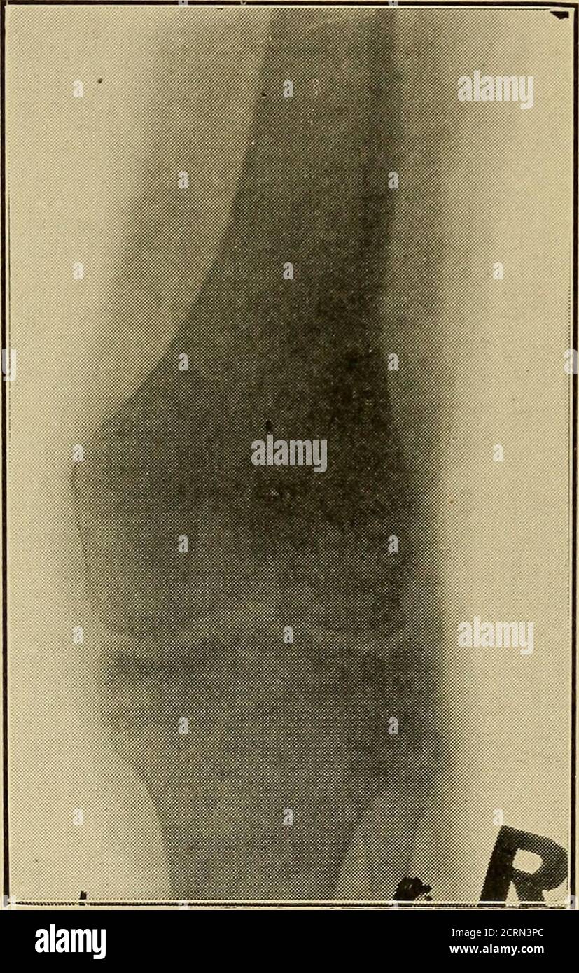 . Diseases of bones and joints . Fig. 41. Hereditary syphilis of the ...