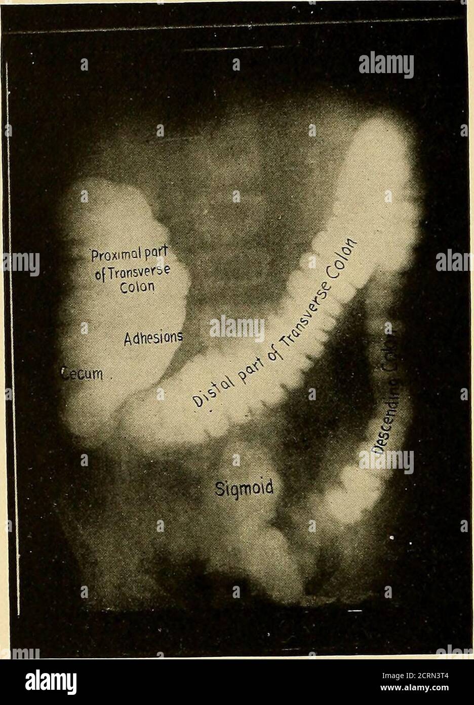 A Manual Of X Ray Technic Fig 46 —adhesions Of Proximal Colon To