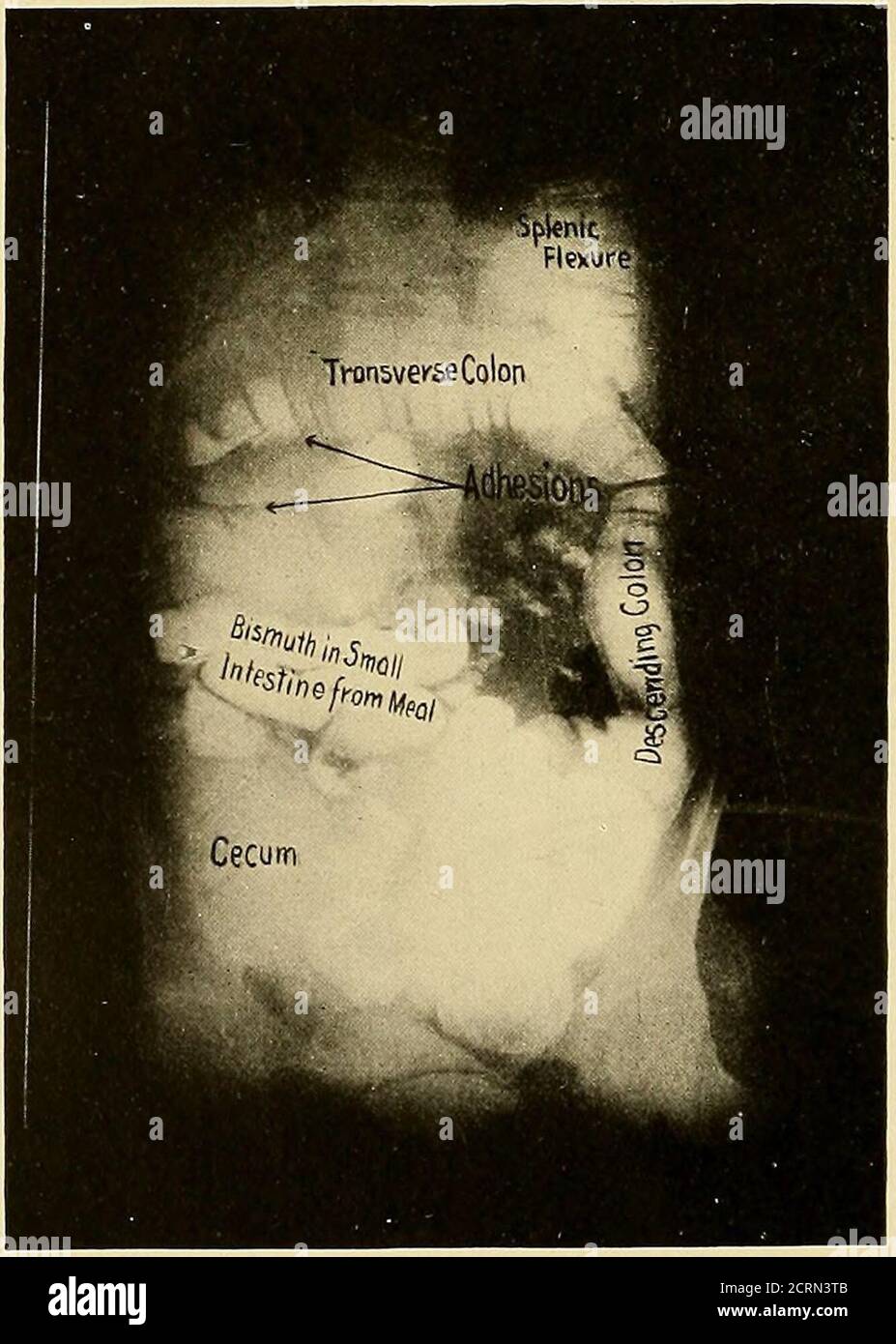 . A manual of X-ray technic . Fig. 46.—Adhesions of proximal colon to ...