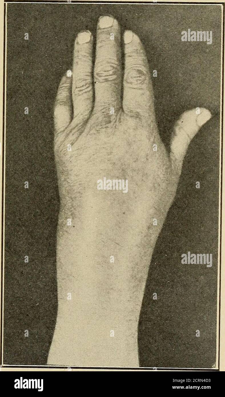 . Diseases of bones and joints . e joint itself. In rareinstances the ...
