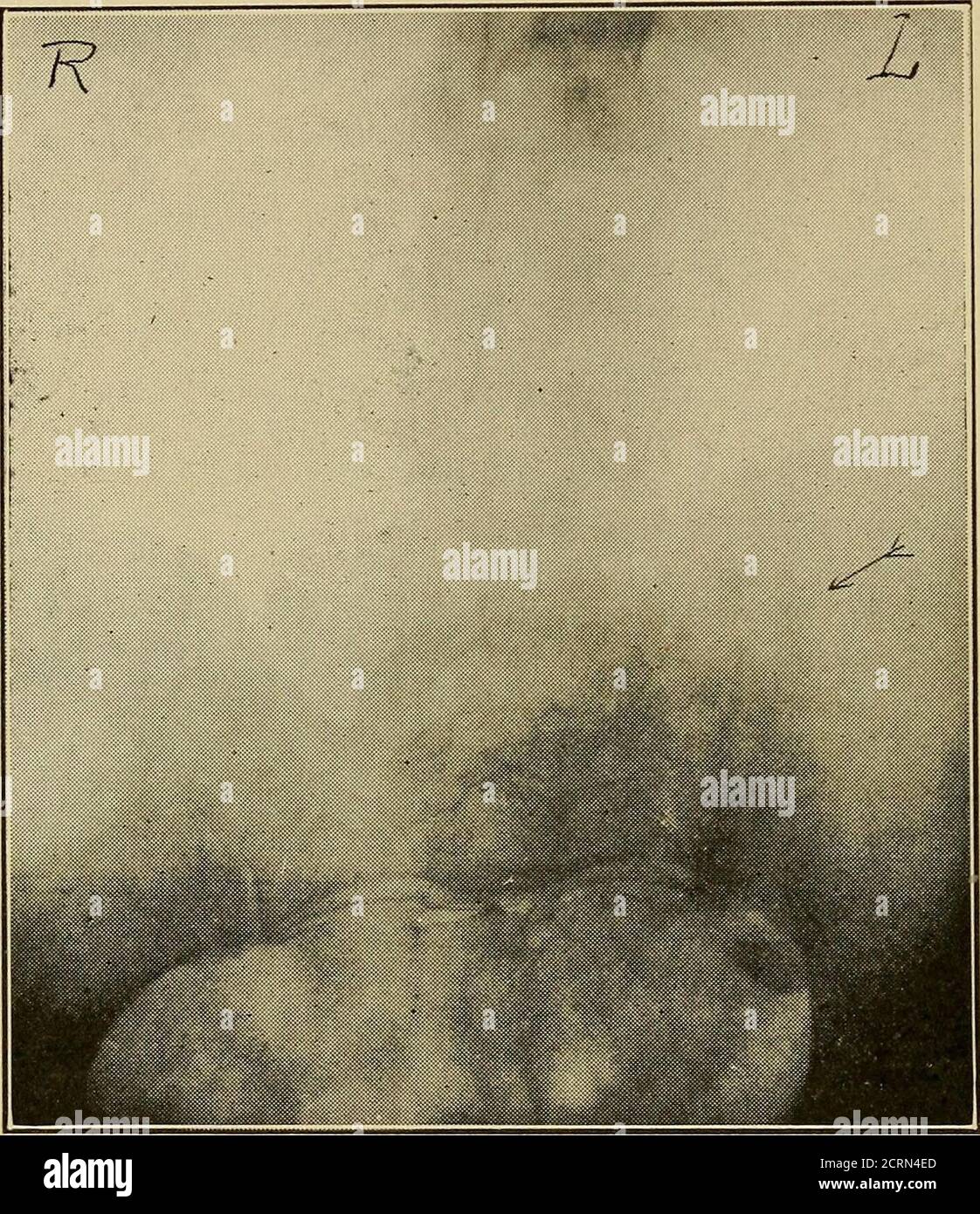 Necrotic mass hi-res stock photography and images - Alamy