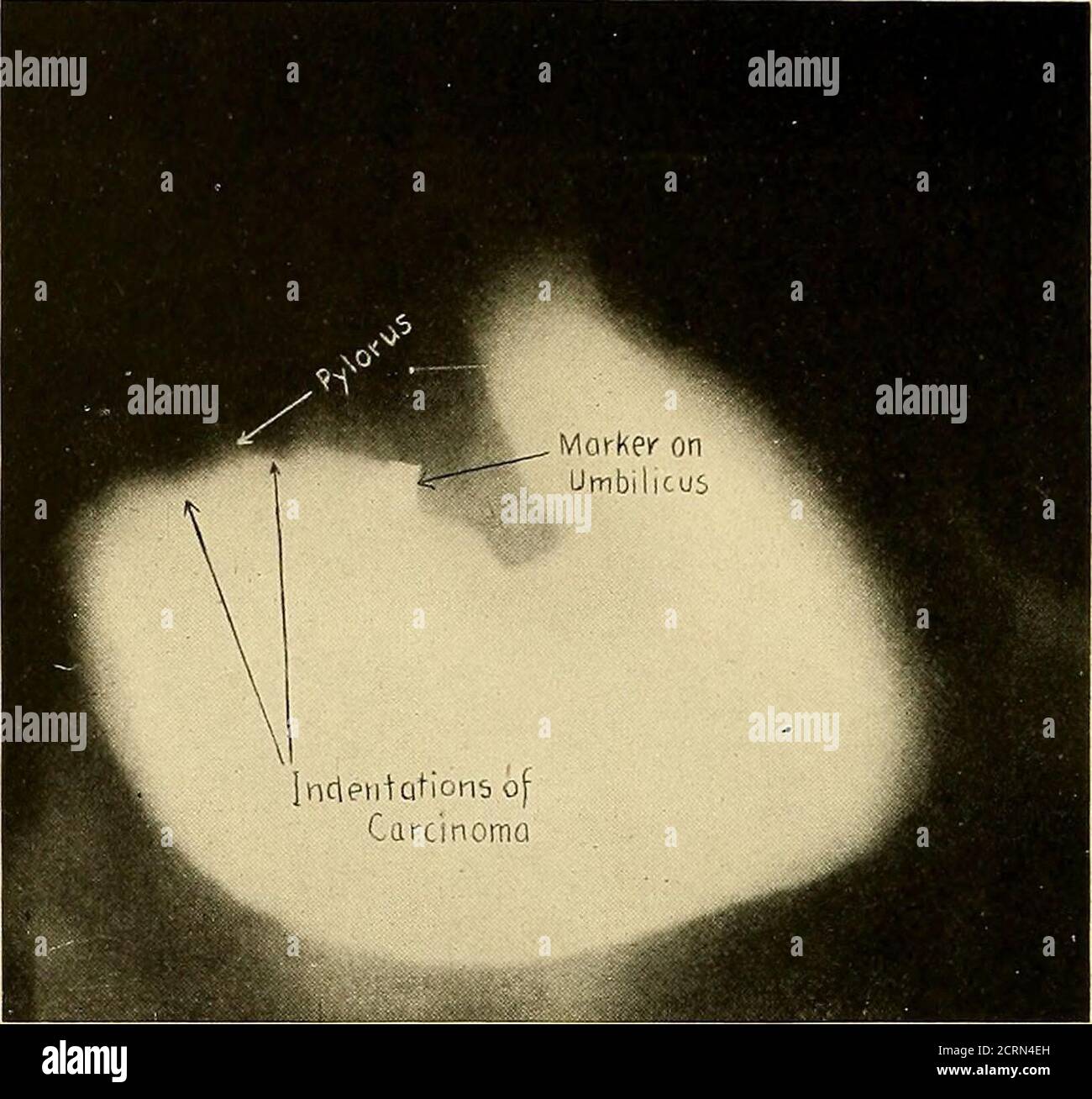 . A manual of X-ray technic . Dilatotion ofStomachDue to Obstructions ...
