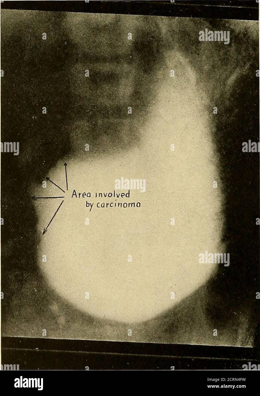 . A manual of X-ray technic . Fig. 40.—Annular carcinoma at pylorus ...