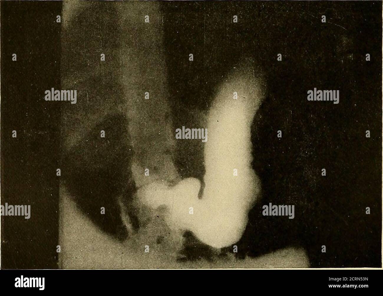 . A manual of X-ray technic . Fig. 28.—Types of normal stomach and ...