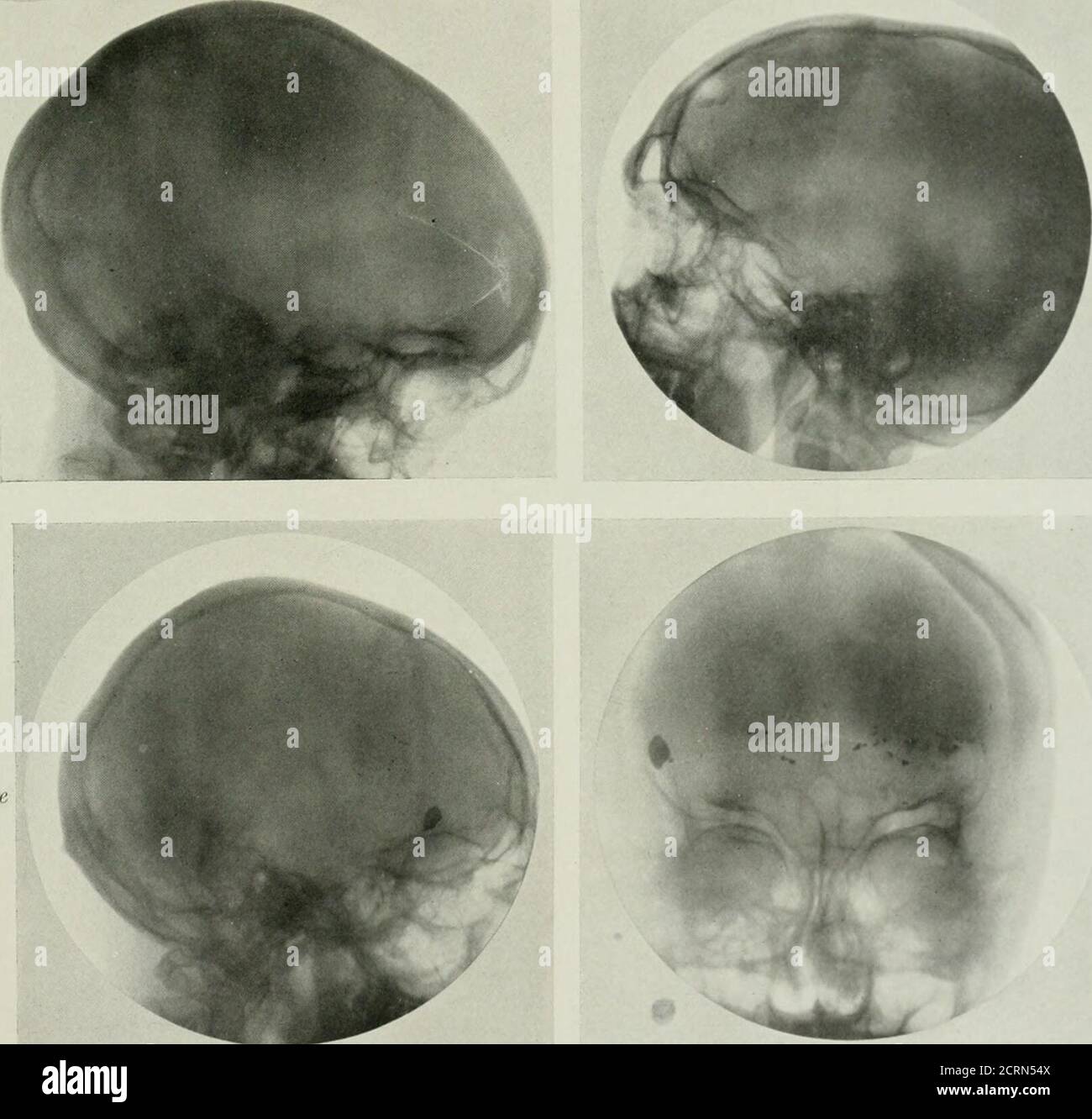Entrance wound gunshot hi-res stock photography and images - Alamy
