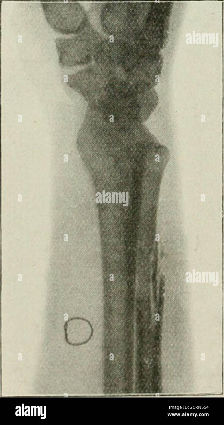 . Radiography and radio-therapeutics . Fig. 163.—Fracture of tibia ...
