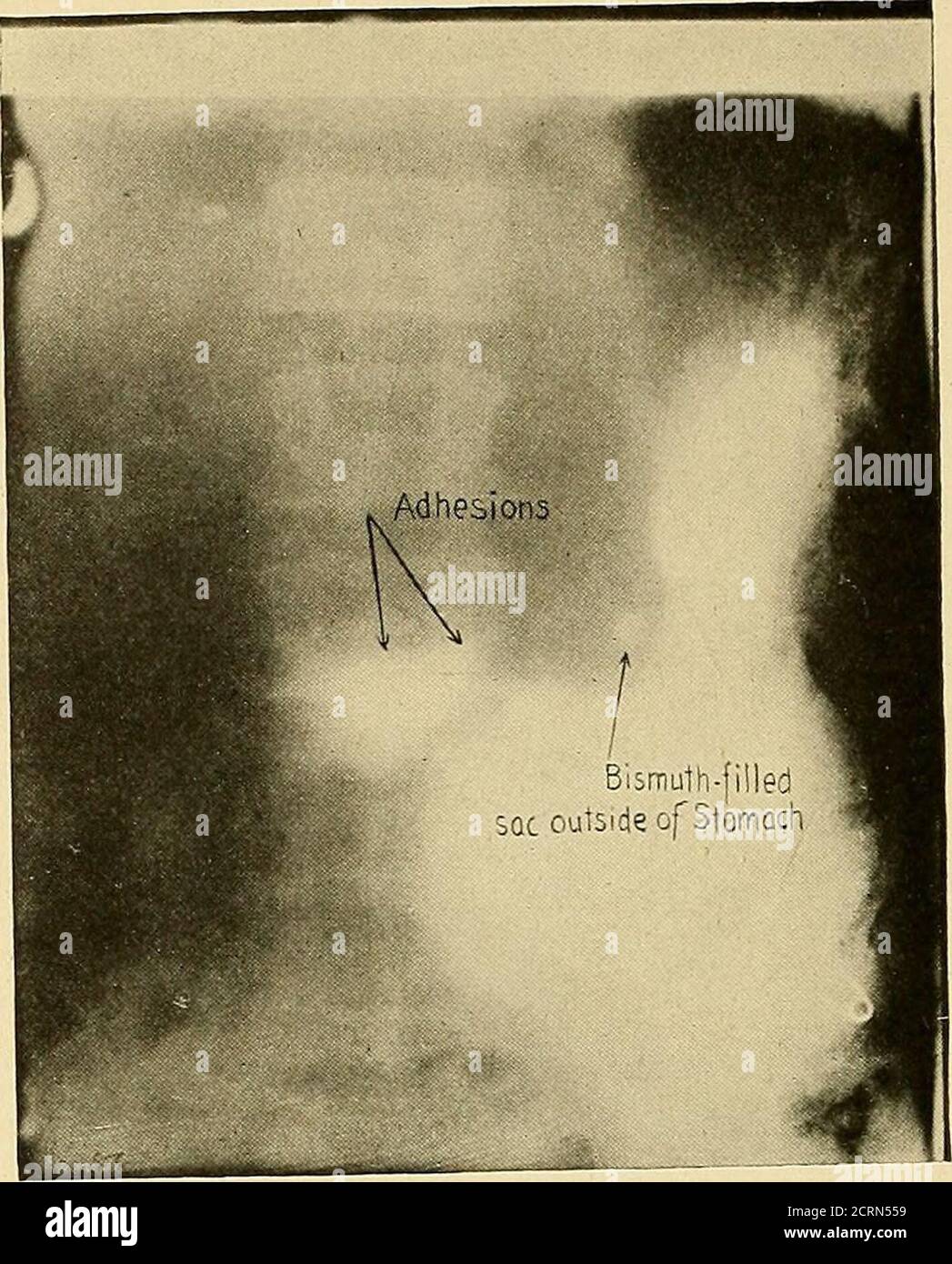 . A manual of X-ray technic . Fig. 31.—Atonic stomach.. Fig. 32 ...