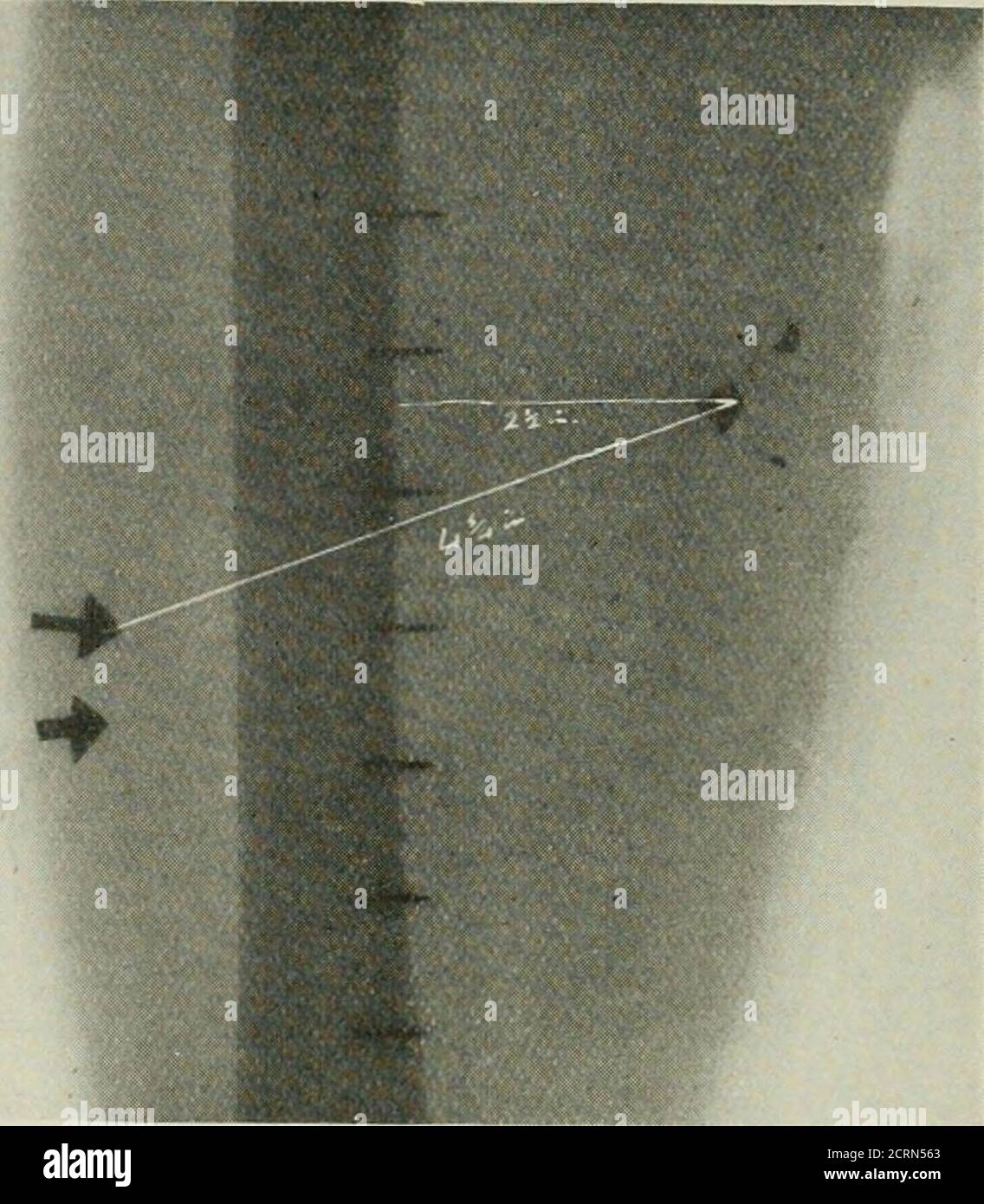 . Radiography and radio-therapeutics . Fig. 163.—Fracture of tibia ...
