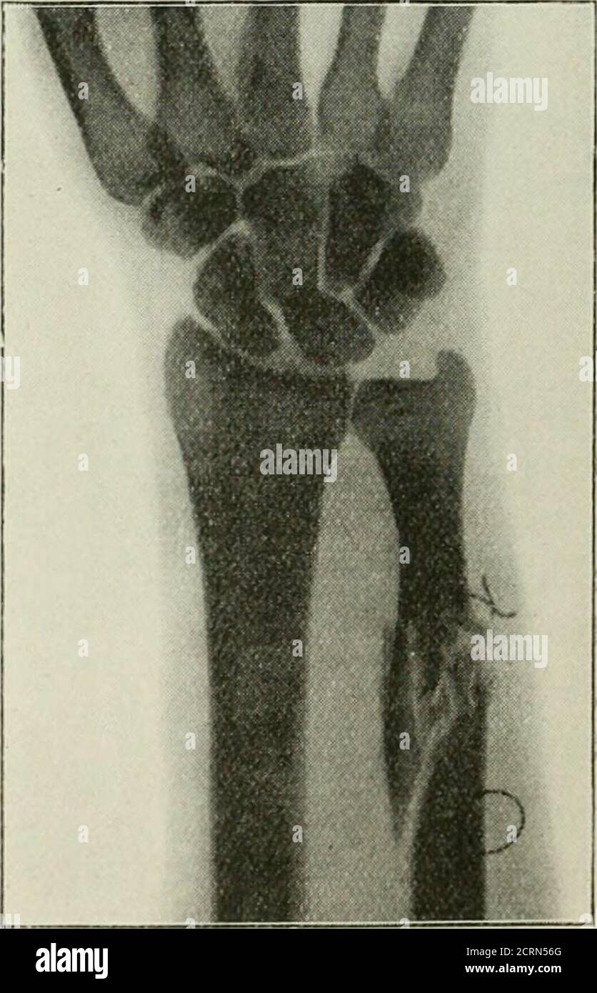 . Radiography and radio-therapeutics . Fig. 165.—Fracture of sliaft of ...