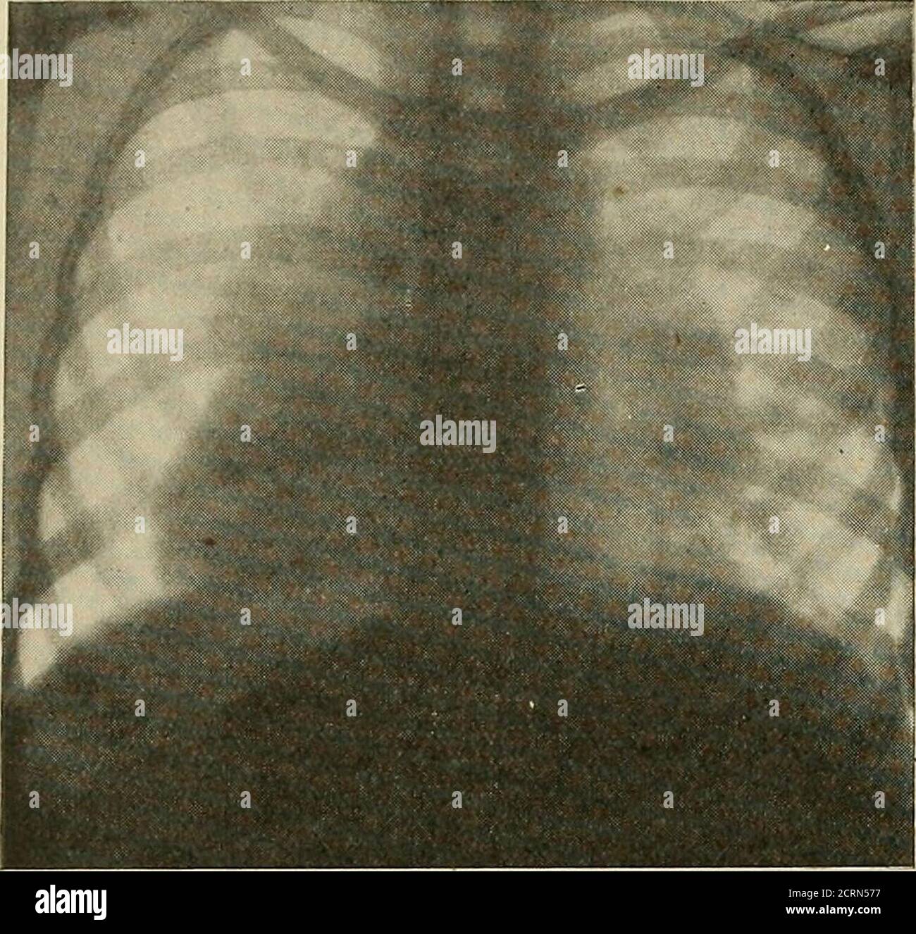 Mediastinal radiography hi-res stock photography and images - Alamy
