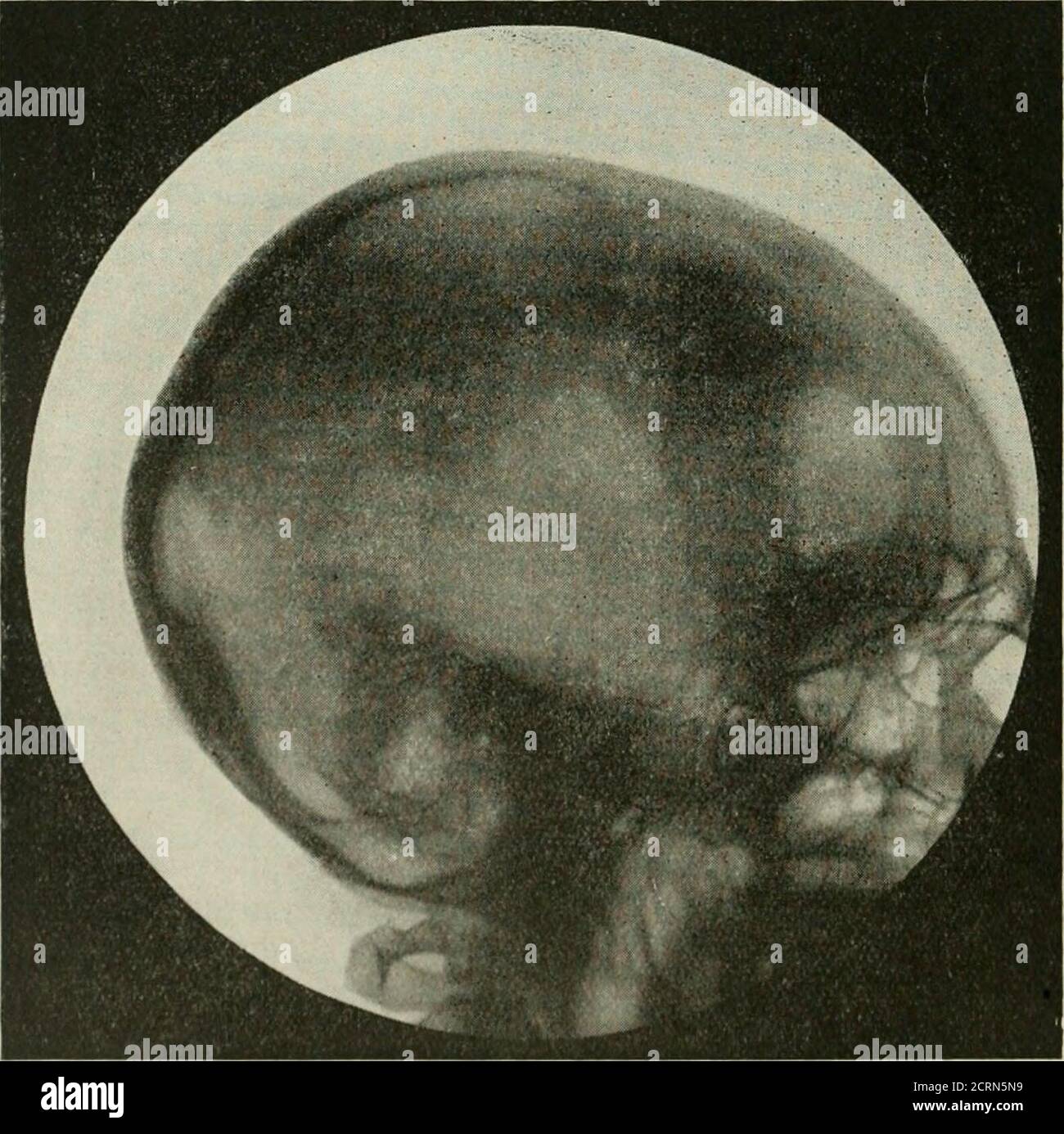 . Radiography and radio-therapeutics . Fig. 159.—Shrapnel bullet in ...