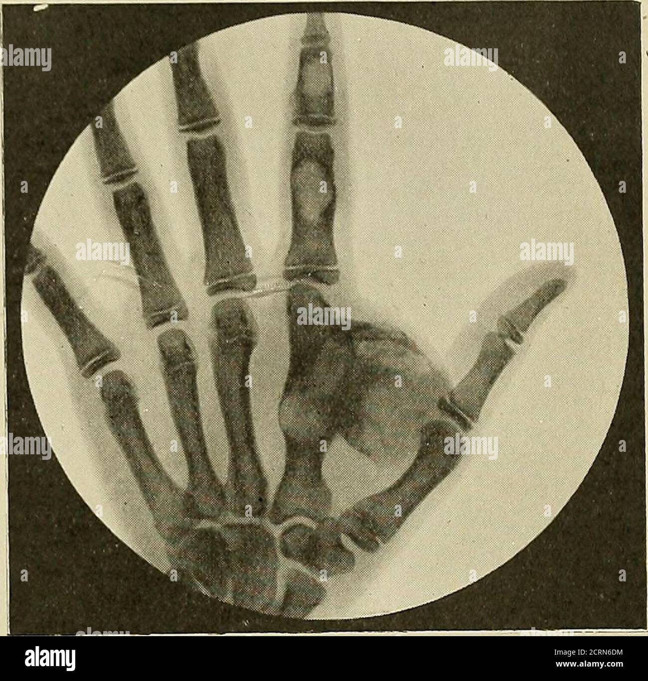 . Radiography and radio-therapeutics . DIFFERENTIAL DIAGNOSIS OF ...