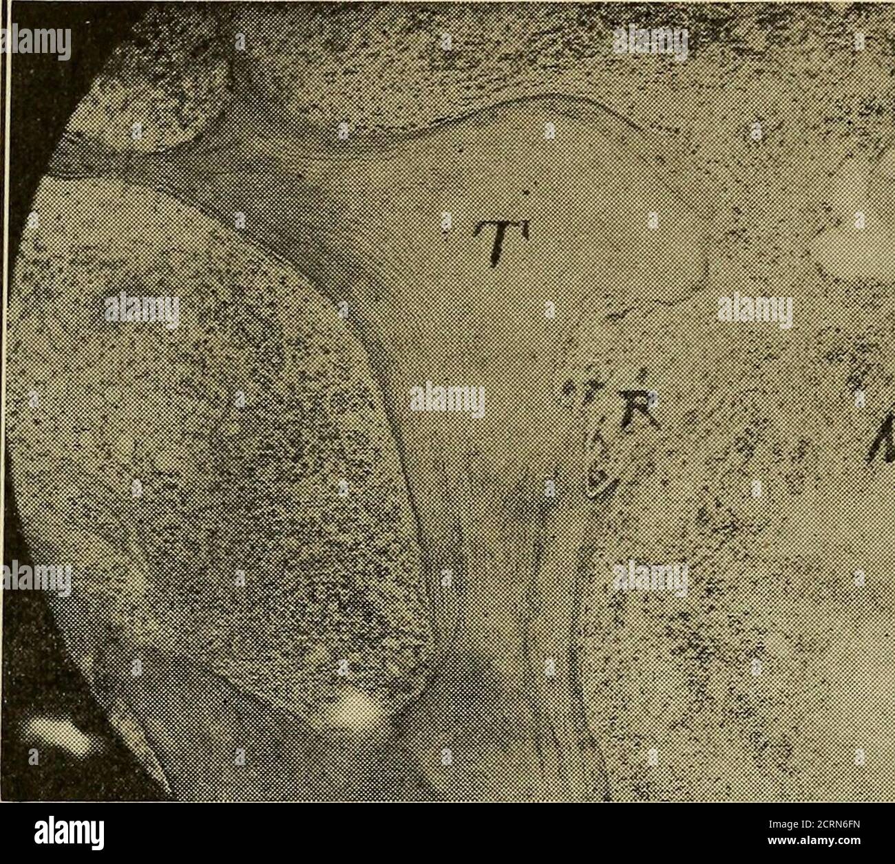 . Diseases of bones and joints . Fig. 3. Photomicrograph of section ...