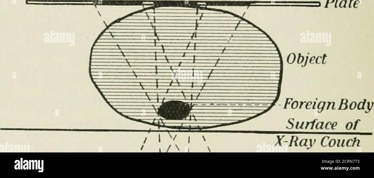 . Radiography and radio-therapeutics . Tube. I / I I Foreign Body ...