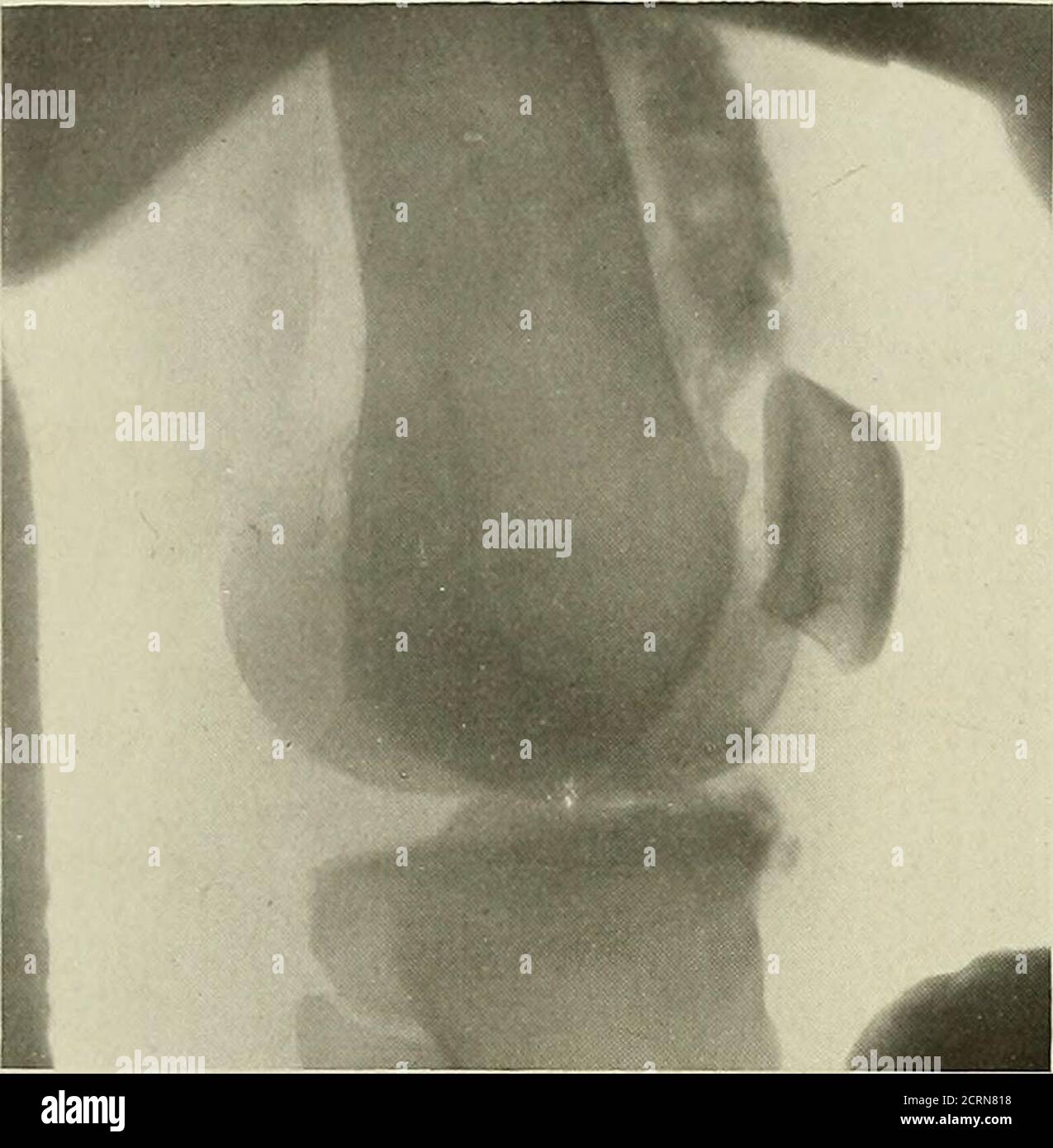 . Radiography and radio-therapeutics . PLATE XLII.—-Tuberculosis of ...