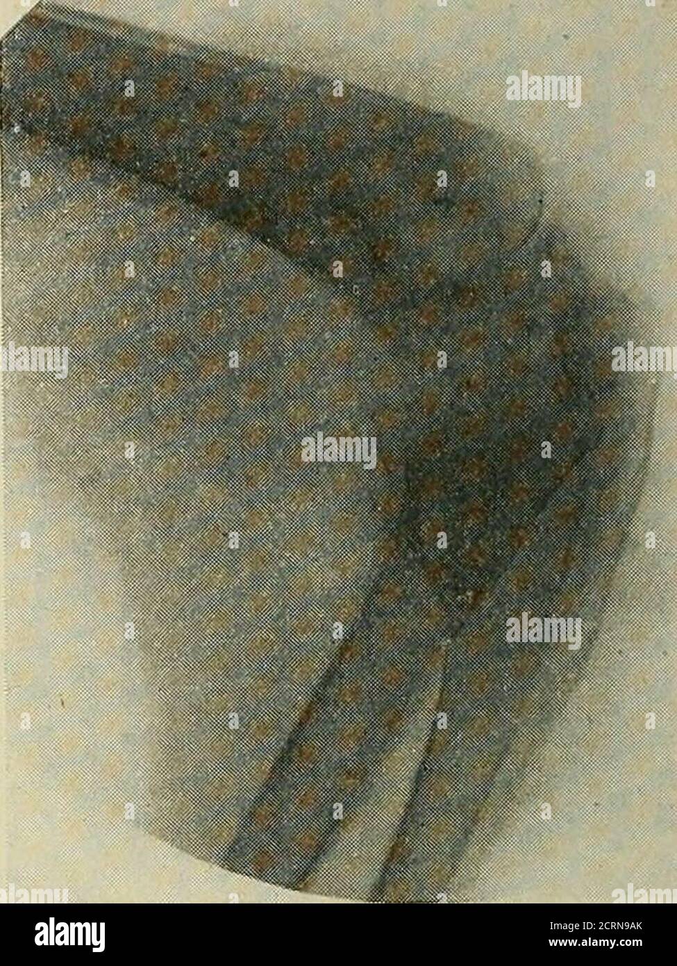 . Radiography and radio-therapeutics . Fig. 226.- -Typhoid osteitis and ...