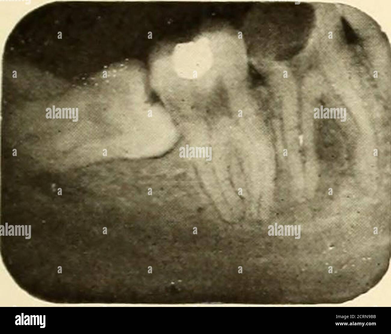 Oral Roentgenology : a Roentgen study of the anatomy and pathology of ...