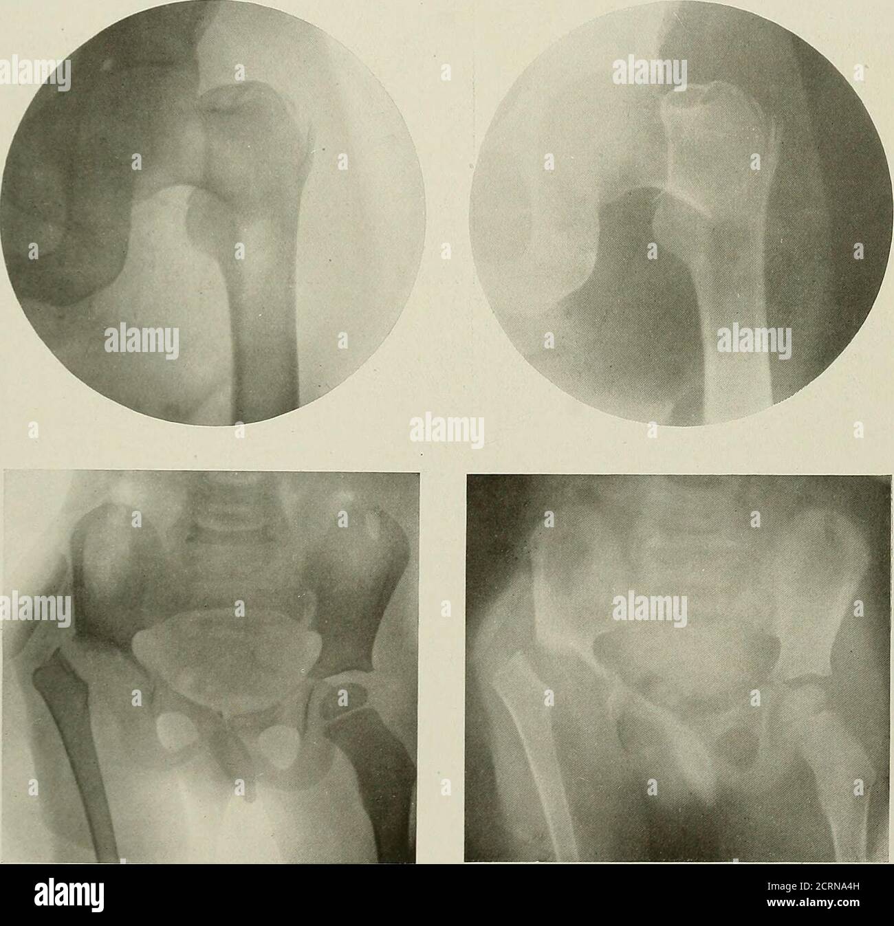 . Radiography and radio-therapeutics . PLATE XXXII.—Injuries and ...