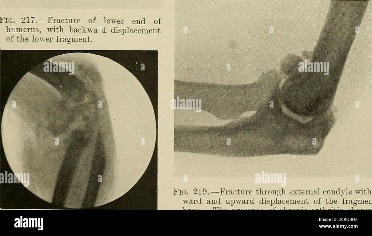 Callus formation hi-res stock photography and images - Alamy