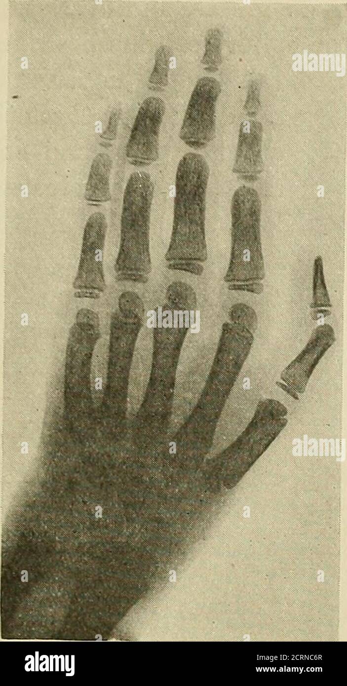 . Radiography and radio-therapeutics . d. The ulnar epiphysis has not ...