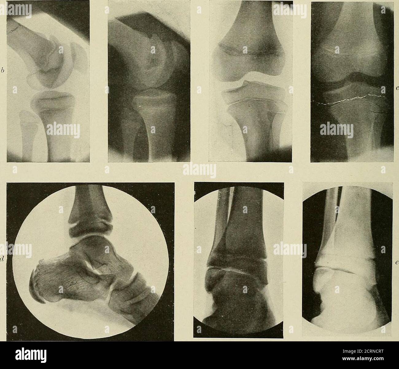 . Radiography and radio-therapeutics . PLATE XXIV.—Showing Epiphyses of ...
