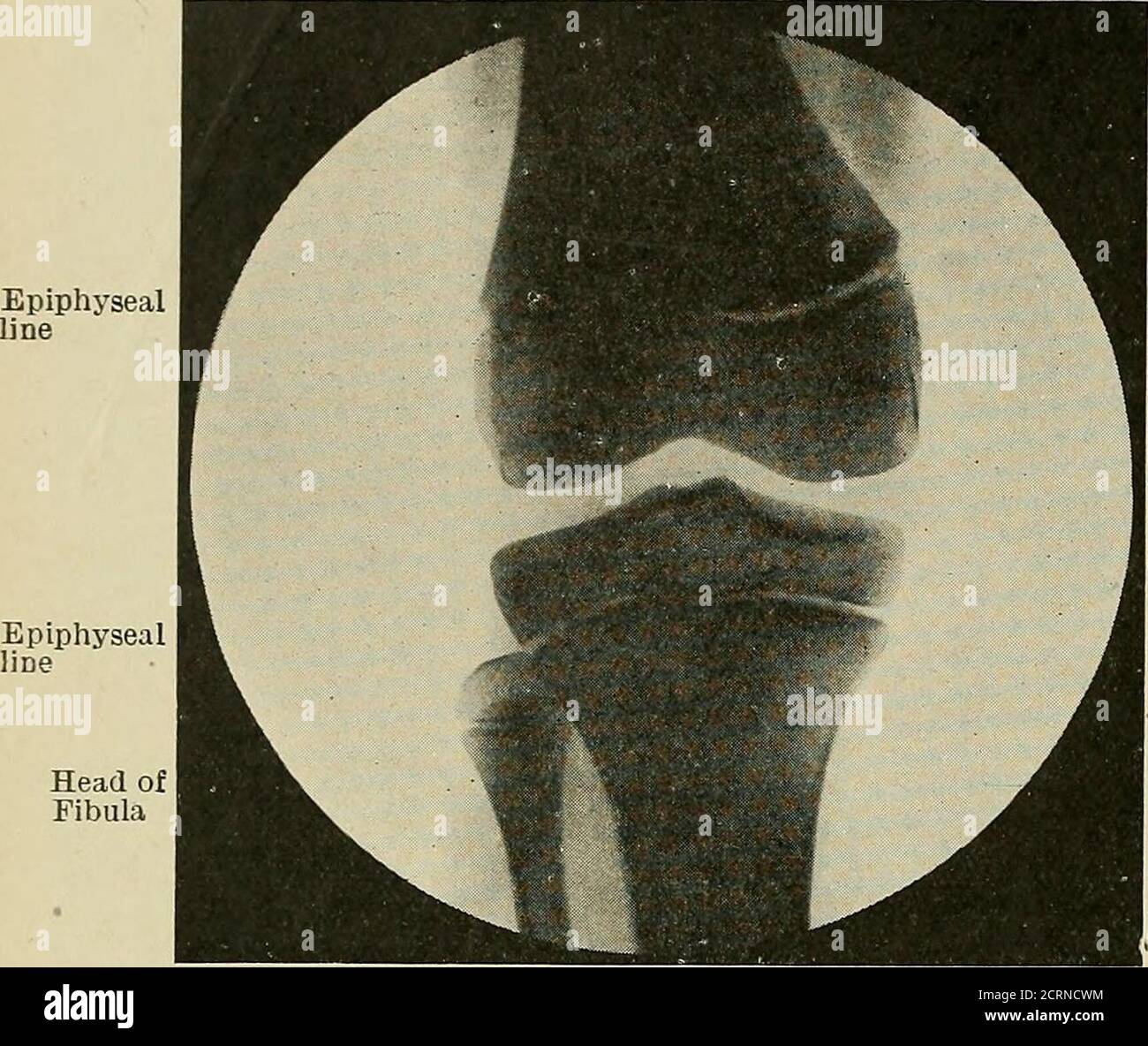 . Radiography and radio-therapeutics . Fig. 192.—Lateral view of knee ...