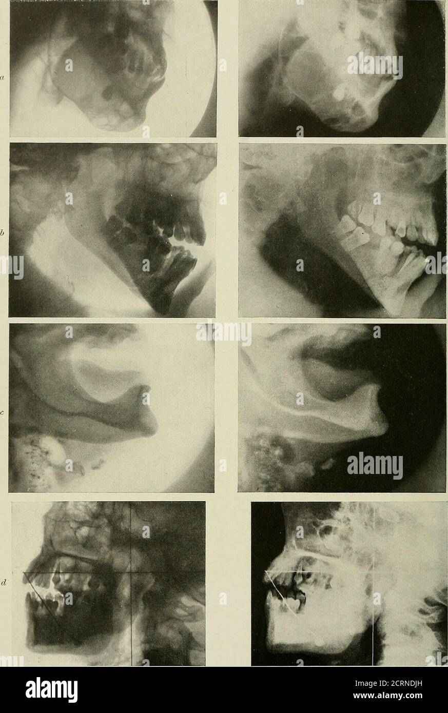 . Radiography and radio-therapeutics . PLATE XVIII.—Dental Films and ...