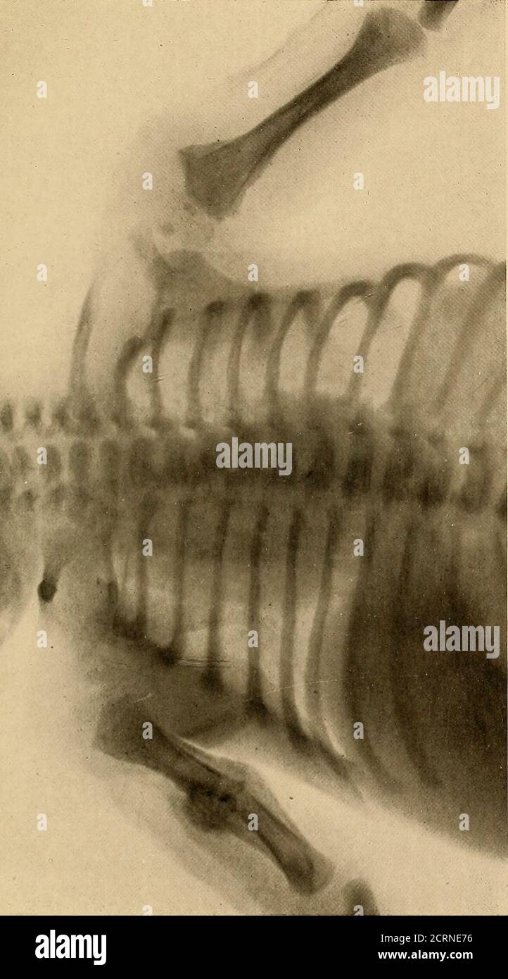 . Birth fractures and epiphyseal dislocations . Fig. ISO.—Case i. Birth ...