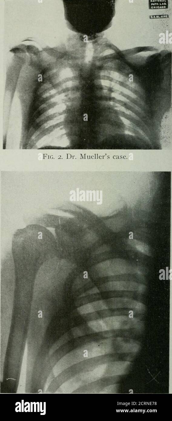 Bone Fusion High Resolution Stock Photography and Images - Alamy