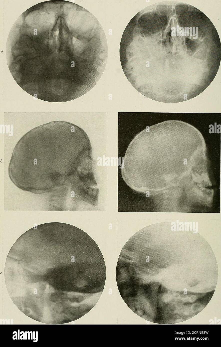 . Radiography and radio-therapeutics . PLATE XVI.—Normal Skulls. a ...