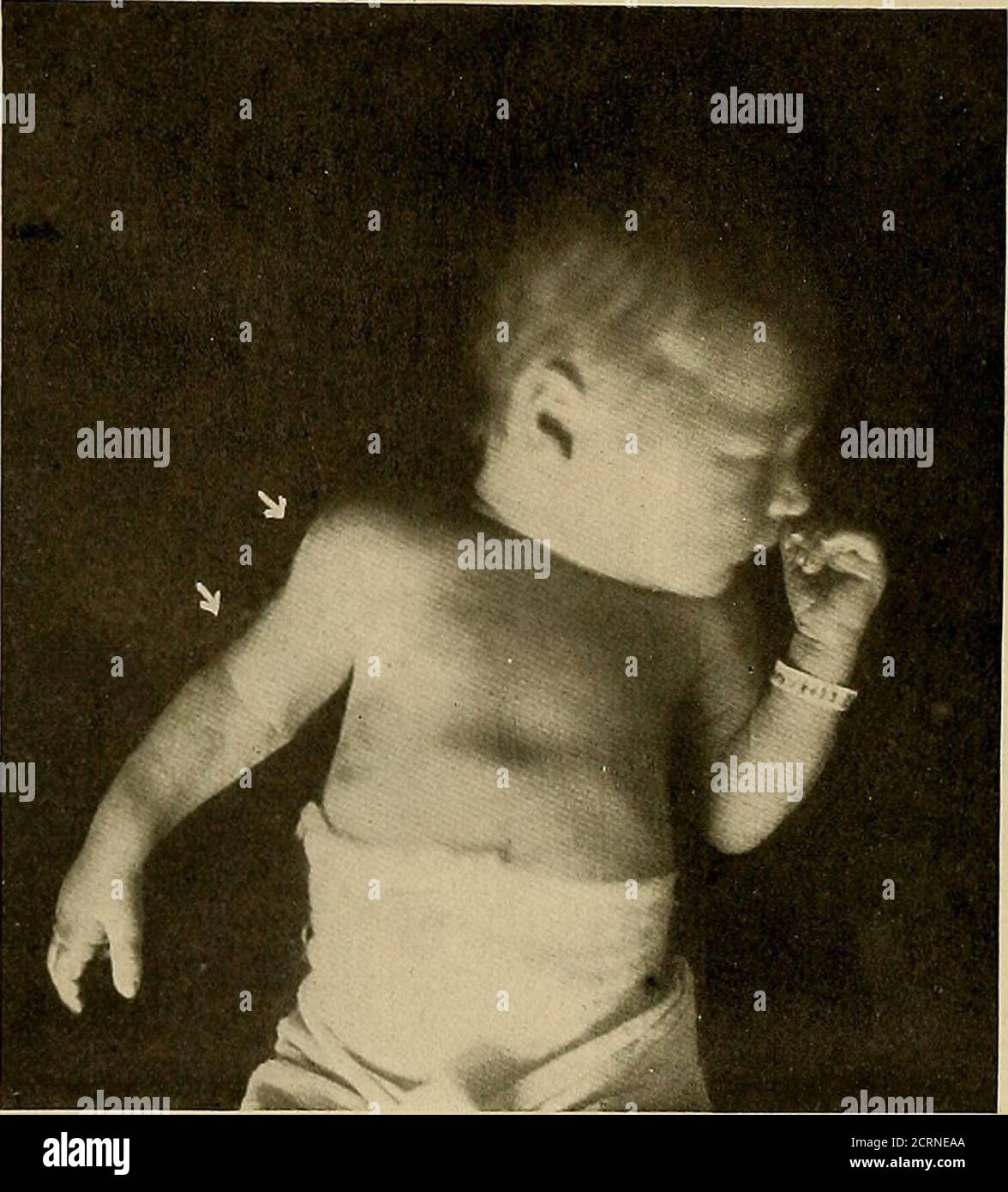 . Birth fractures and epiphyseal dislocations . ssection from still ...