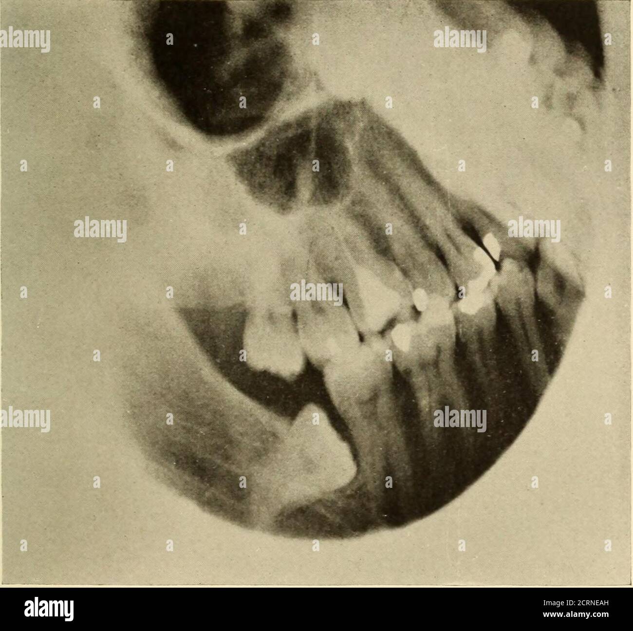 Unerupted wisdom tooth hi-res stock photography and images - Alamy