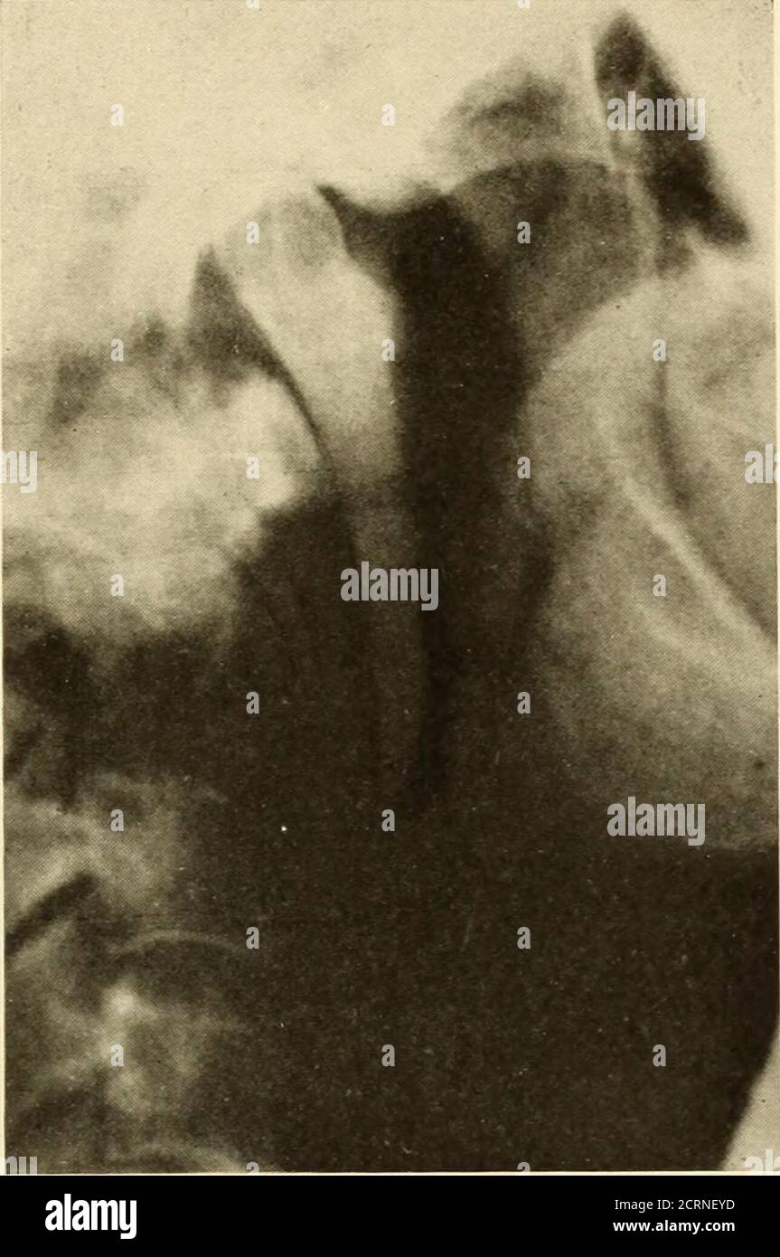 Mandibular notch hi-res stock photography and images - Alamy
