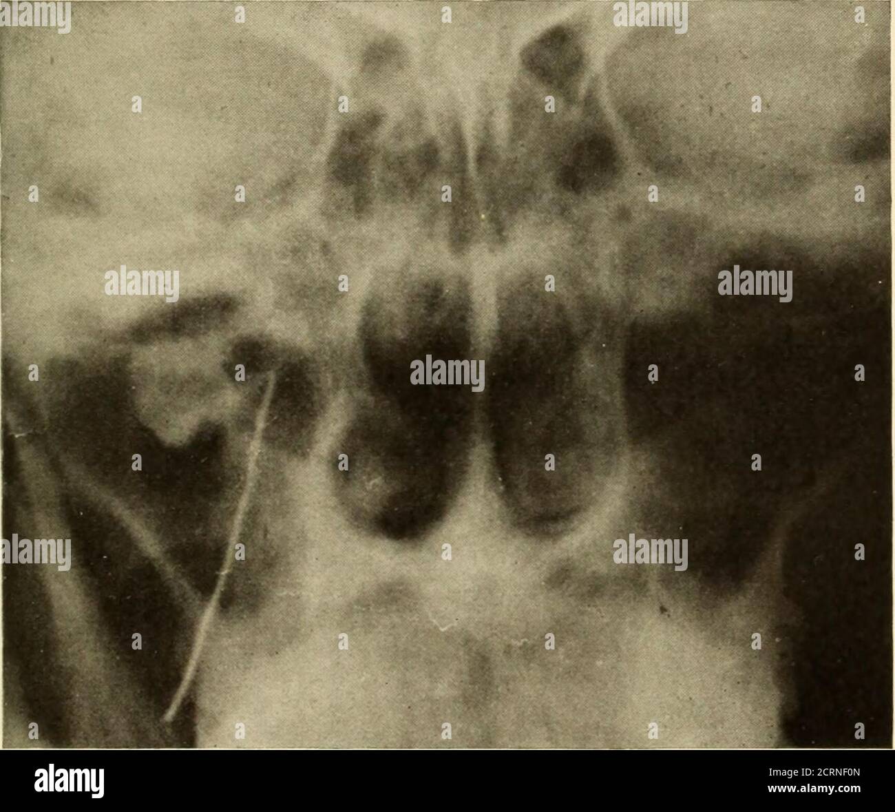 Oral Roentgenology : a Roentgen study of the anatomy and pathology of ...