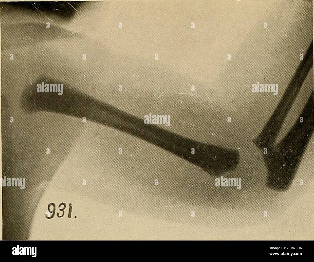 . Birth fractures and epiphyseal dislocations . Fig. 134.—Case 2 ...