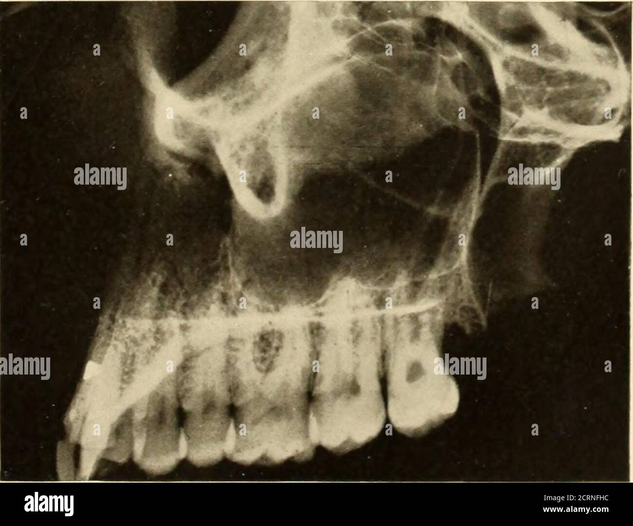 Maxillary Tuberosity Anatomy