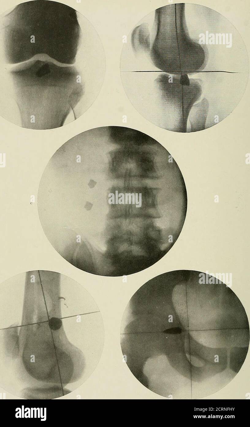 . Radiography and radio-therapeutics . PLATE VIII.— Skull Injuries. a ...