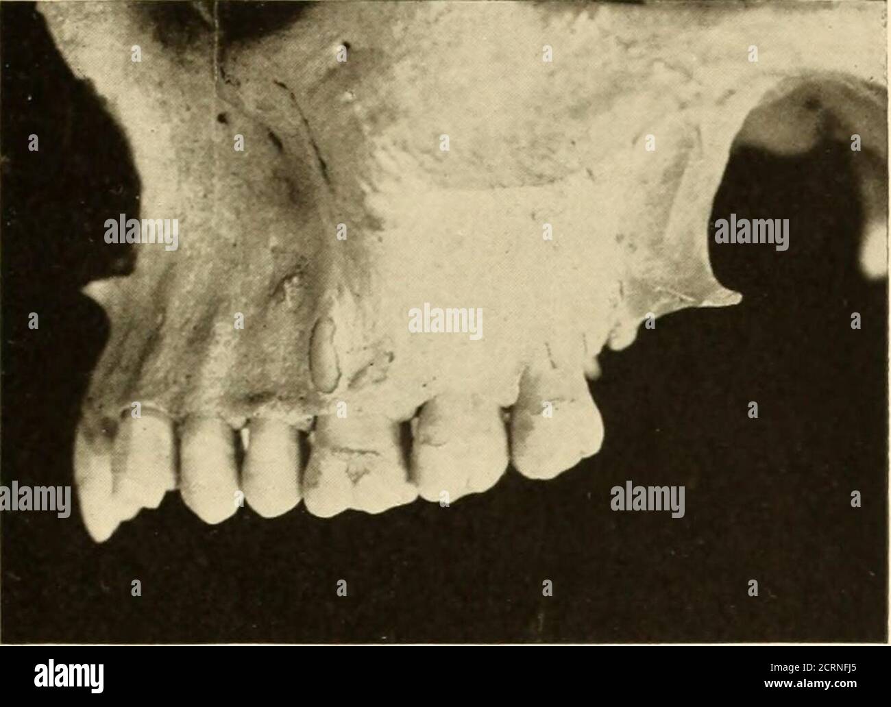 Cortical Plate Of Mandible