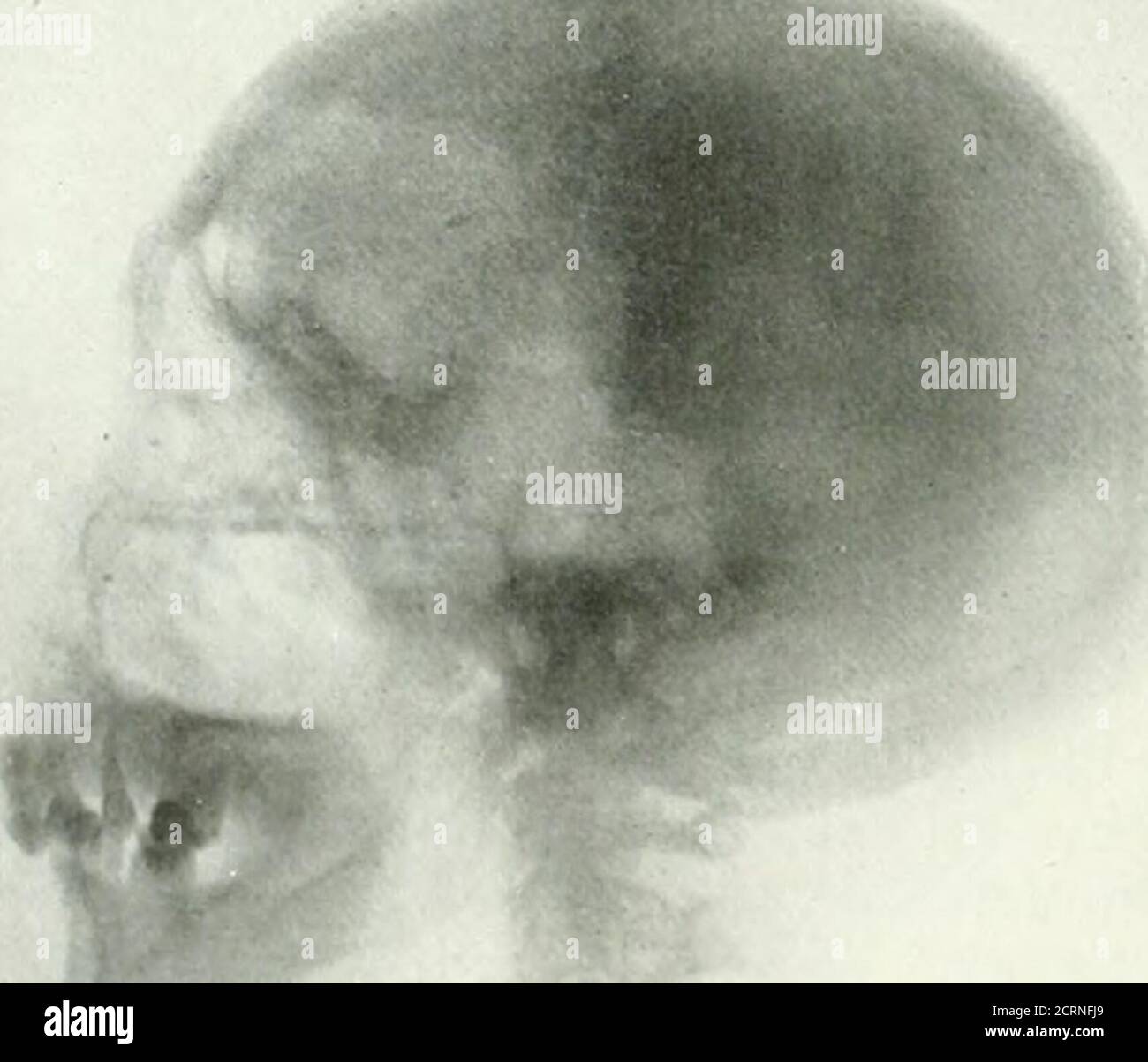 Band of the jaw bone hi-res stock photography and images - Alamy