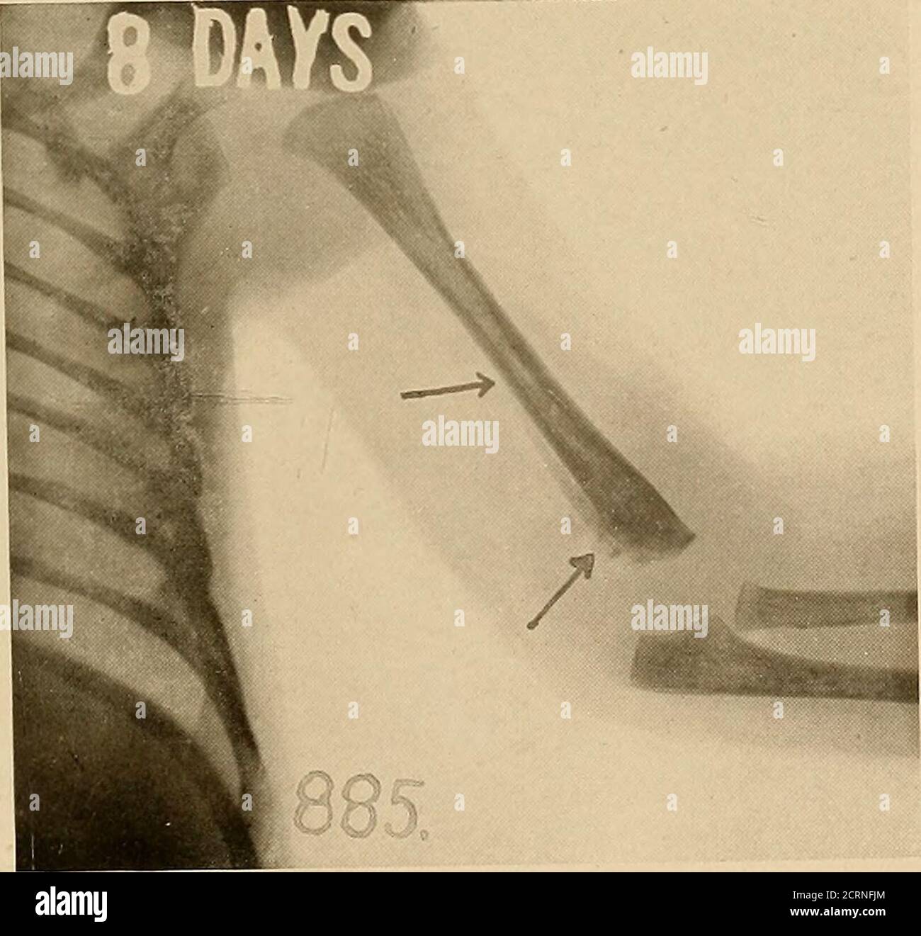 Wedge fracture hi-res stock photography and images - Alamy