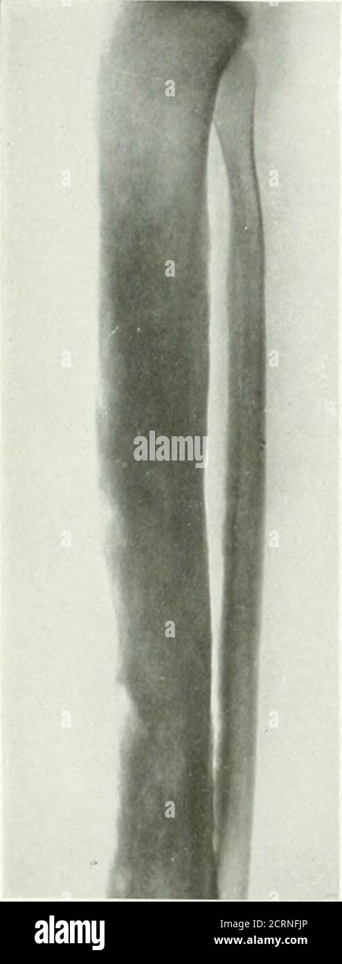 Sarcoma leg hi-res stock photography and images - Alamy