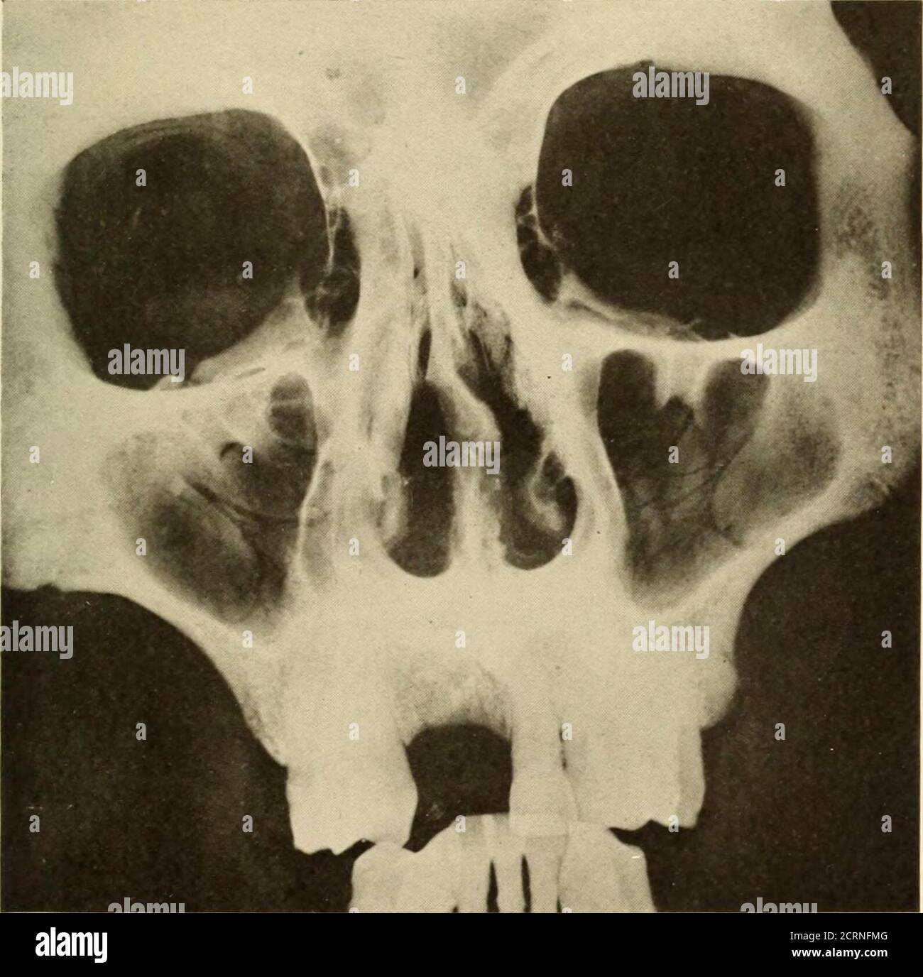 Oral Roentgenology : a Roentgen study of the anatomy and pathology of ...
