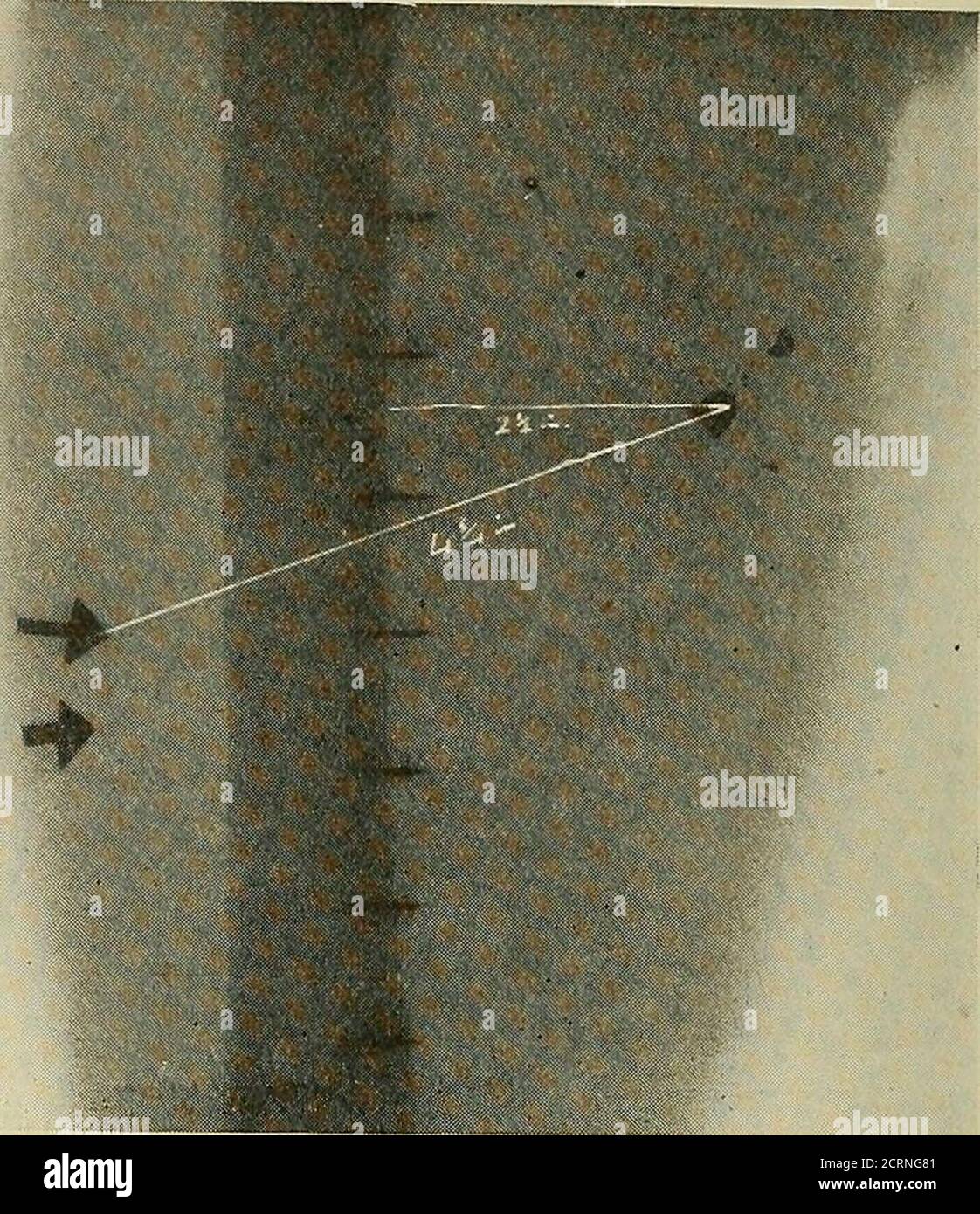 . Radiography and radio-therapeutics . Fig. 163.—Fracture of tibia ...